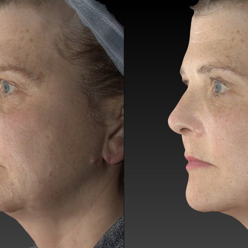 Fat Loss Red Light Therapy Weight Loss Before and After | Contours